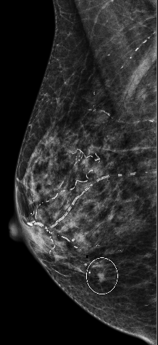 Case 4 – Breast Imaging Teaching Files