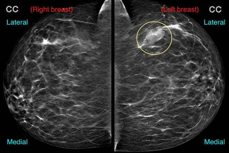Case 12 – Breast Imaging Teaching Files