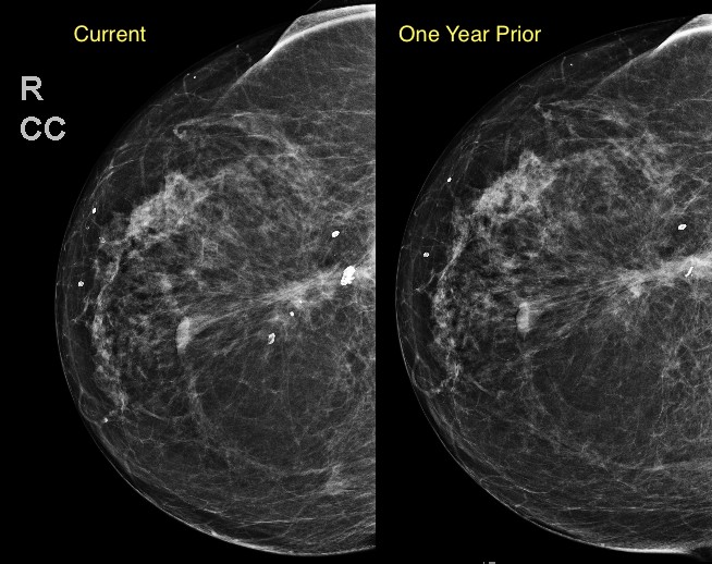 Case 9 – Breast Imaging Teaching Files
