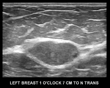 Case 12 – Breast Imaging Teaching Files