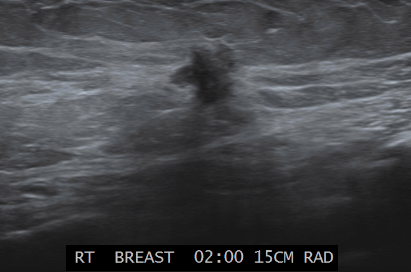 Case 9 – Breast Imaging Teaching Files