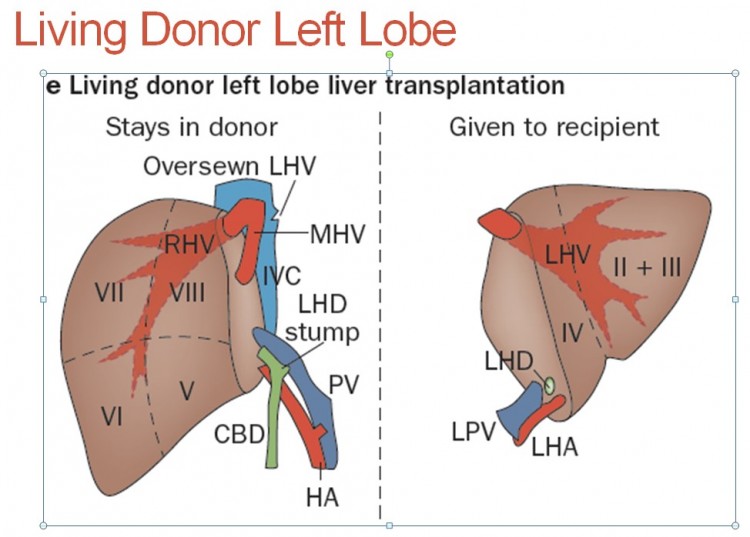 Liver Living Donor | UW MEDICINE ULTRASOUND