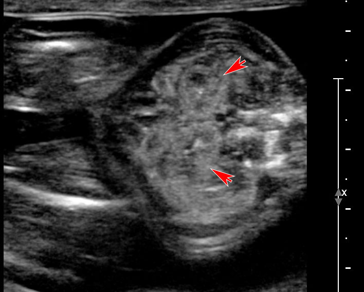 Case 1 | UW MEDICINE ULTRASOUND