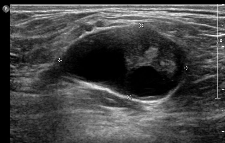 Case 6 | UW MEDICINE ULTRASOUND