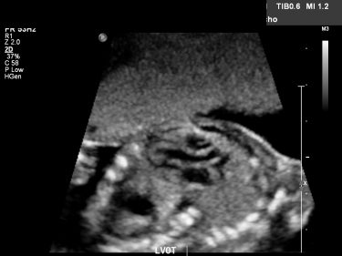 Case 5 | UW MEDICINE ULTRASOUND