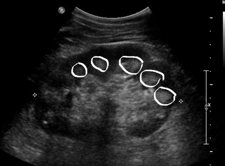 Case 1 | UW MEDICINE ULTRASOUND