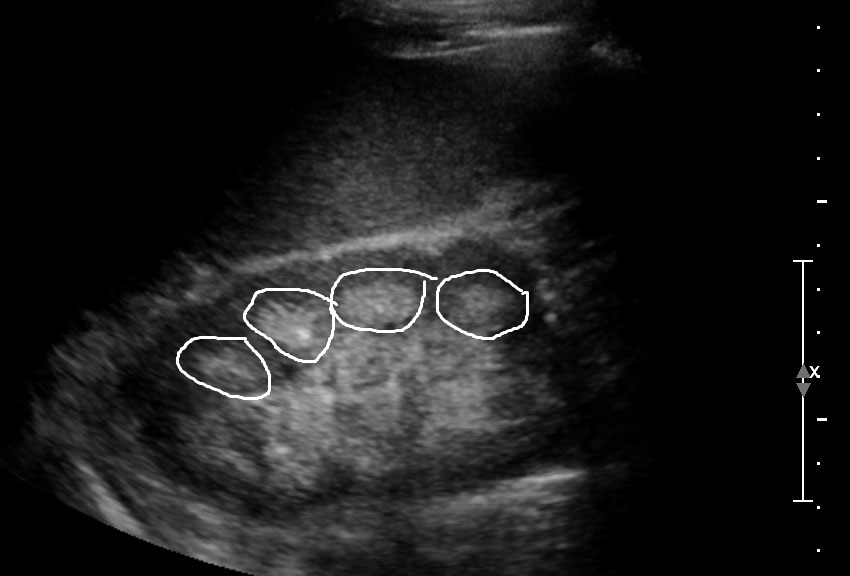 Case 1 | UW MEDICINE ULTRASOUND
