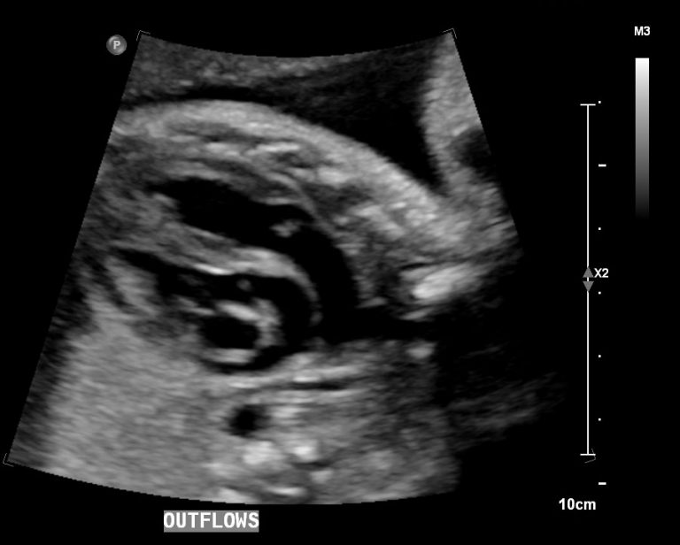 Transposition of Great Arteries | UW MEDICINE ULTRASOUND